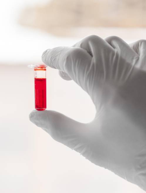 Análisis De Creatinina Sérica en Mérida, Yucatán - Dr. Raúl F. Olais Chan